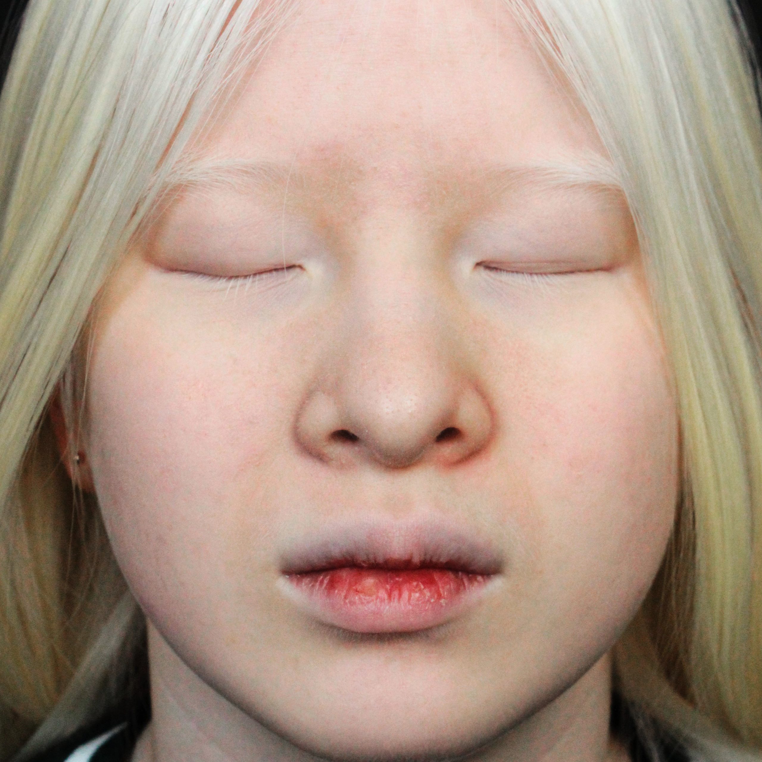 MEET UN GOODWILL AMBASSADOR AND ALBINISM ACTIVIST XUELI ABBING - Mission